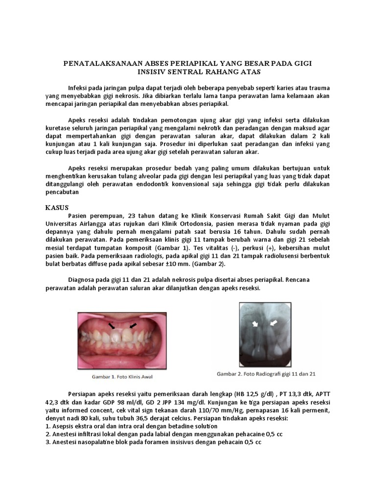 Penatalaksanaan Abses Periapikal Yang Besar Pada Gigi | PDF