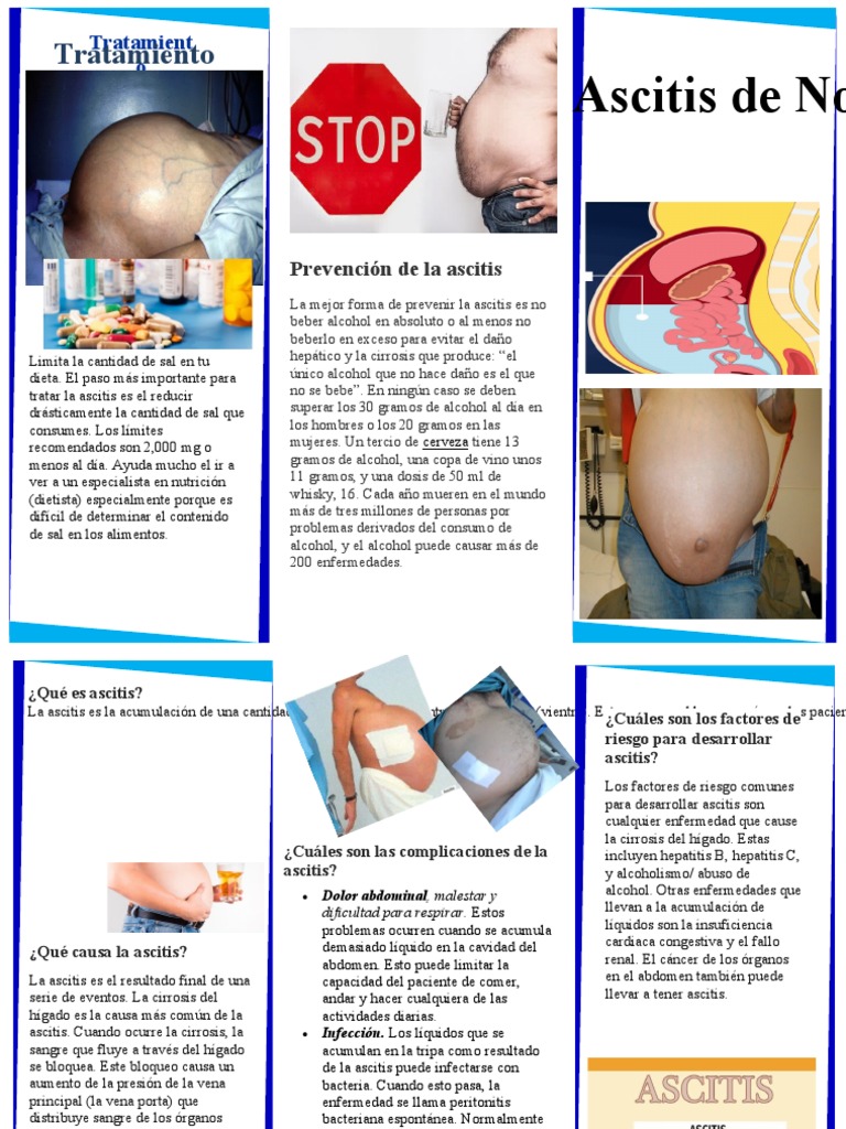 Ascitis de Novo 2 | PDF | Especialidades Medicas | Medicina CLINICA