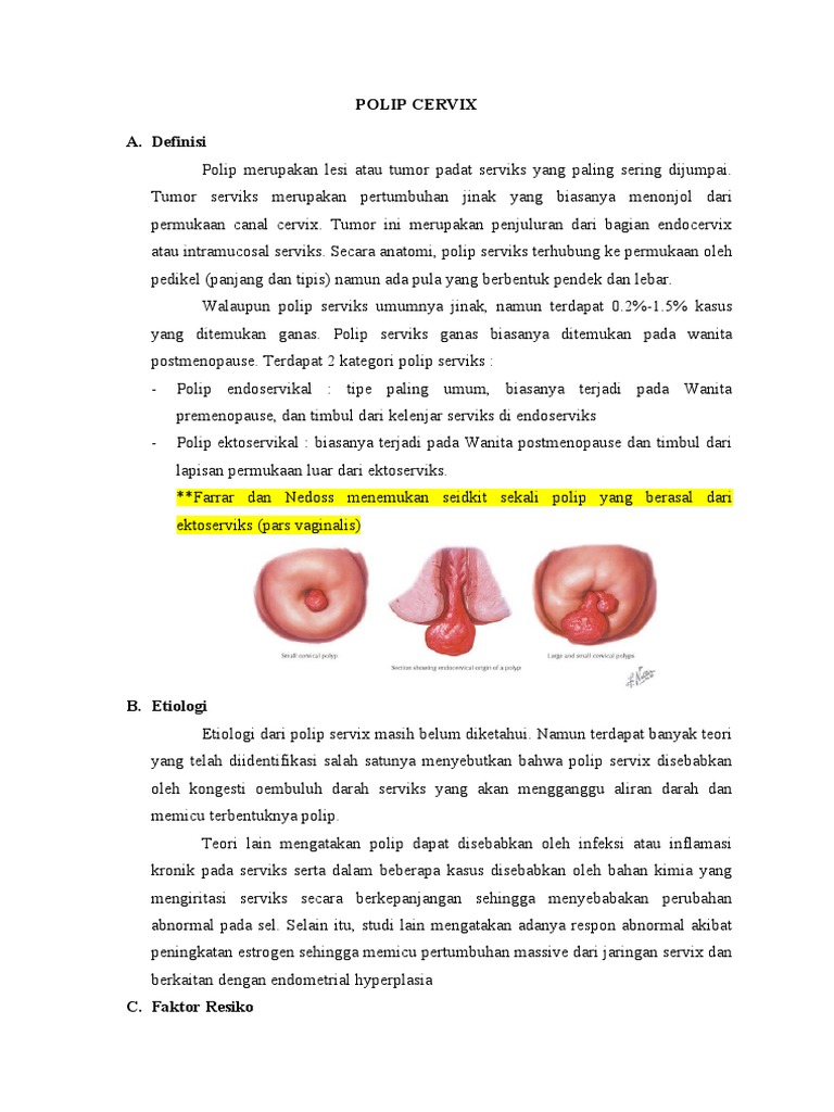 Polip Cervix | PDF