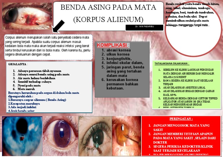 Benda Asing Pada Mata | PDF