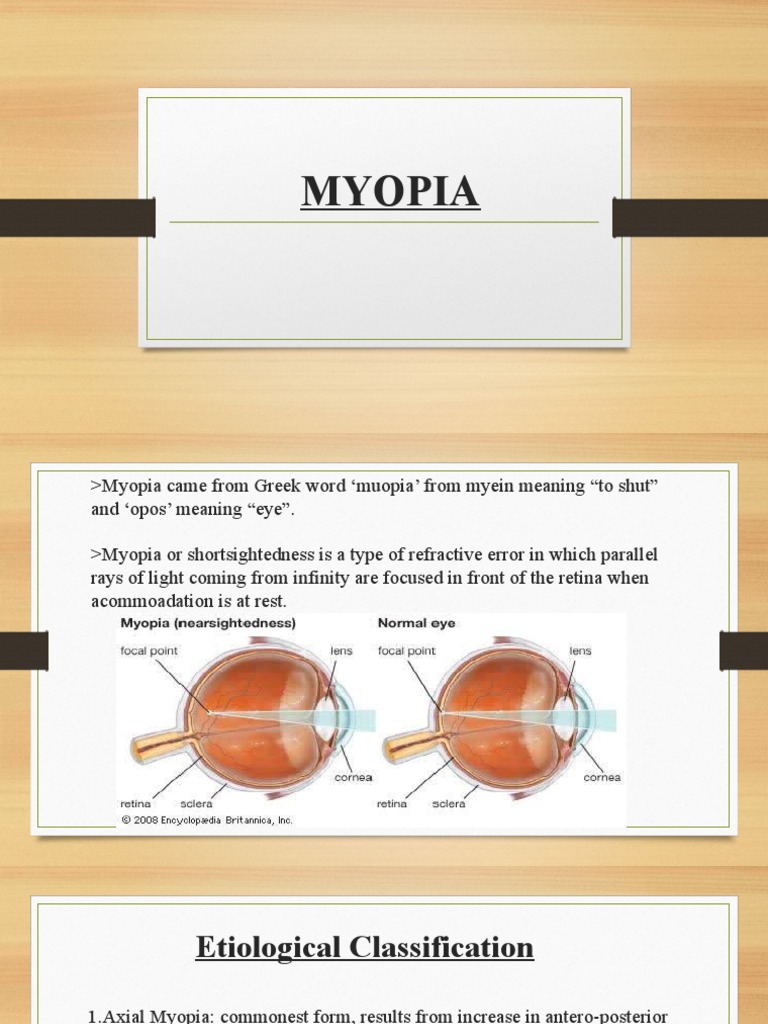 Myopia | PDF | Myopia | Cornea