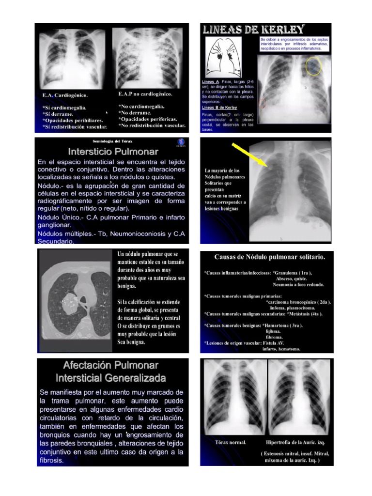 Radiologia Edema Pulmonar | PDF