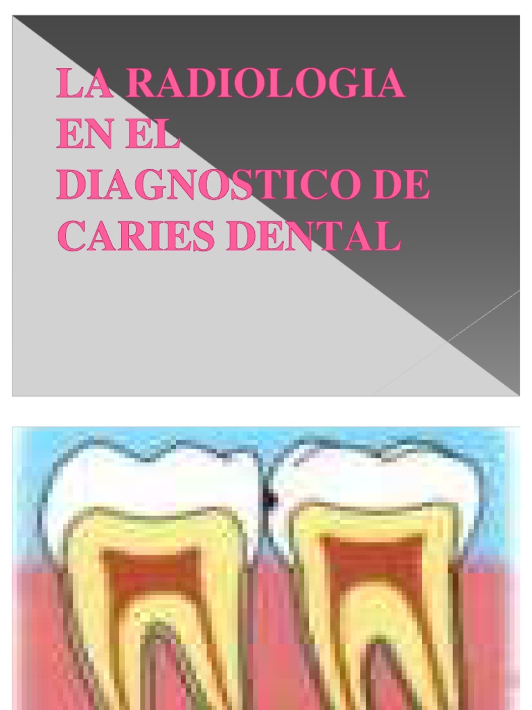 La Radiologia en El Diagnostico de Caries Dental | PDF
