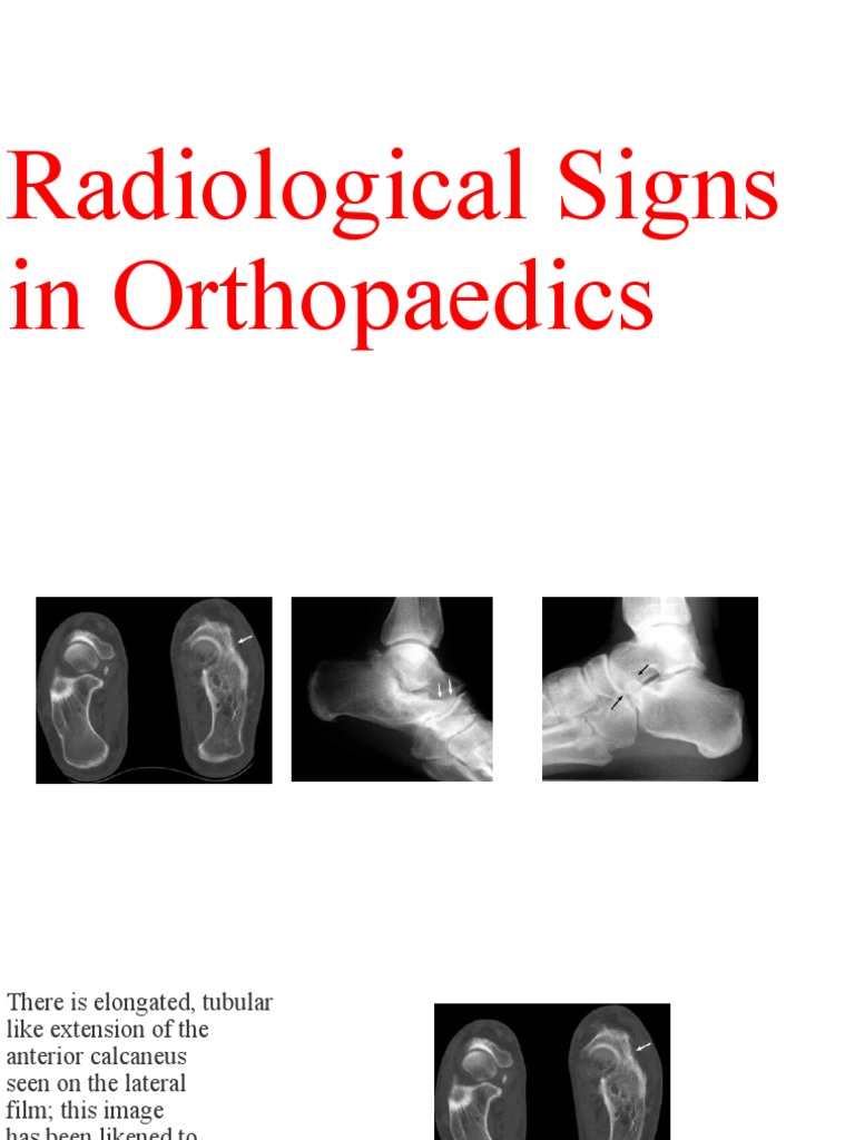 Radiological Signs in Orthopaedic Part 1-1 | Download Free PDF ...