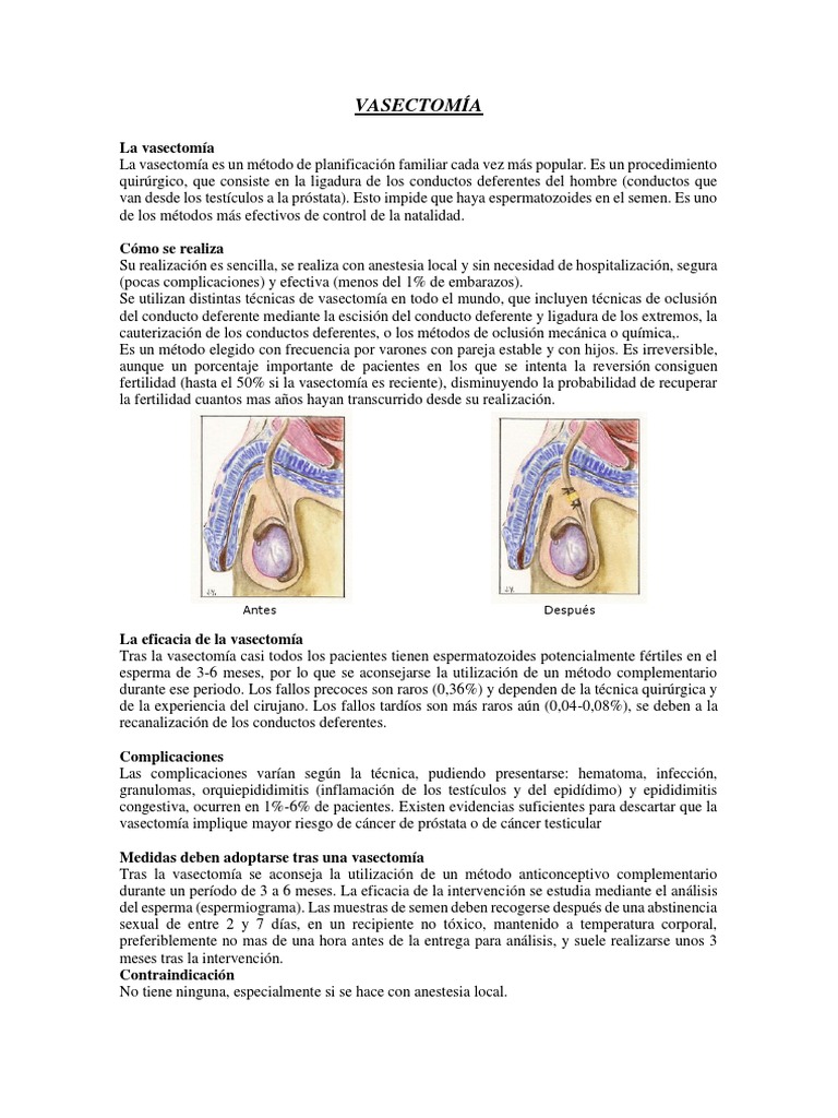 VASECTOMÍA | PDF | Anatomia sexual | Semen