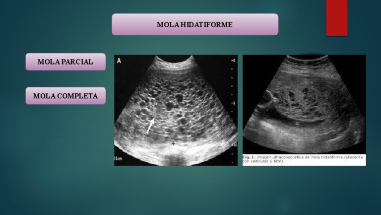 Mola Hidatiforme | PDF