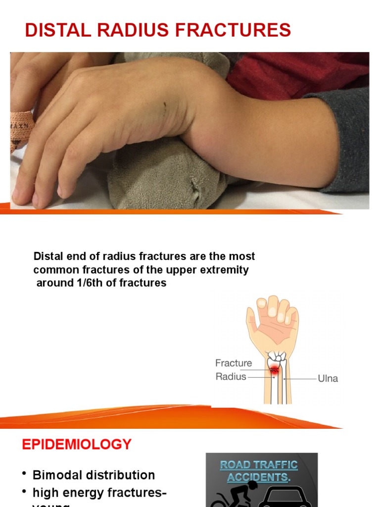 Distal Radius Fractures | PDF | Thumb | Skeletal System