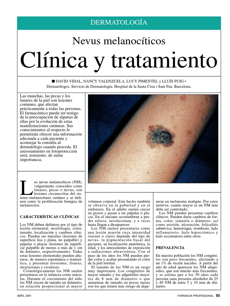 Nevus Melanociticos | PDF | Melanoma | Cáncer