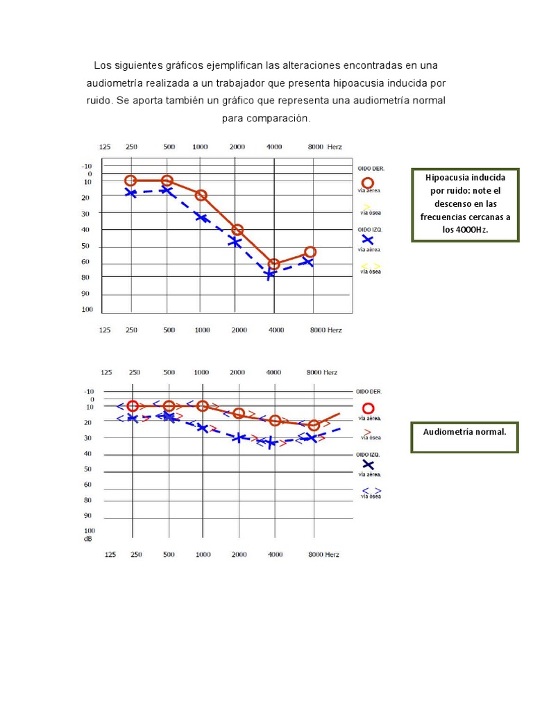 Ejemplos de Audiometrias. | PDF