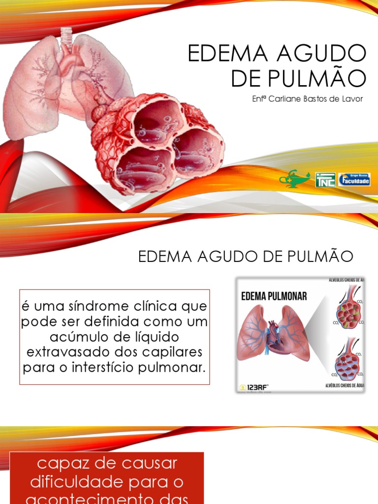 Edema Agudo de Pulmão | PDF | Pulmão | Coração