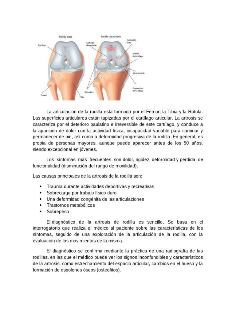 Artrosis (Gonartrosis) | PDF | Rodilla | Osteoartritis