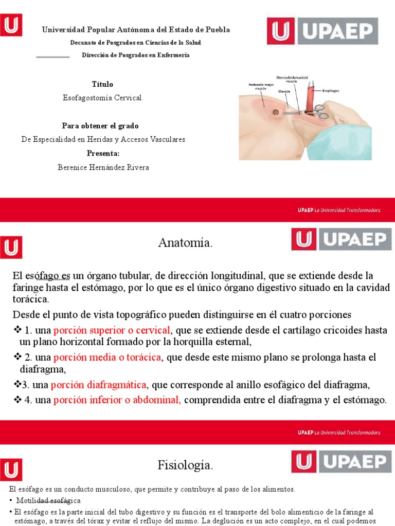 Presentacion de Esofagostomía | PDF