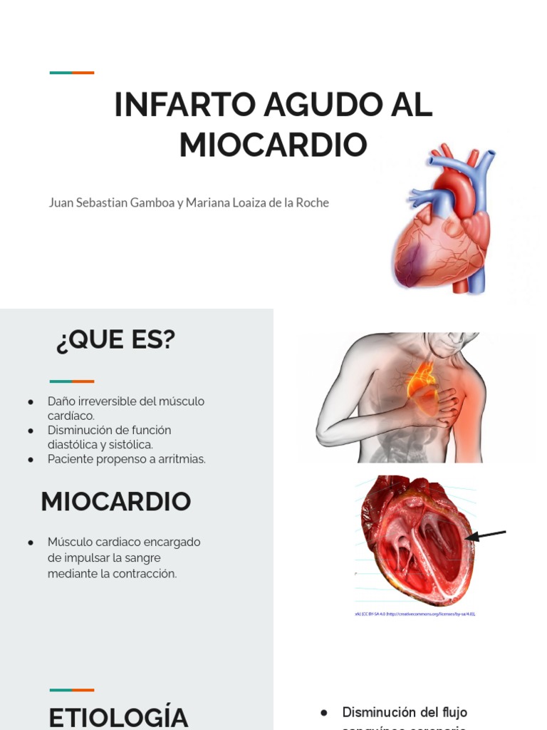 Infarto Agudo al Miocardio: Causas y Clasificación | PDF