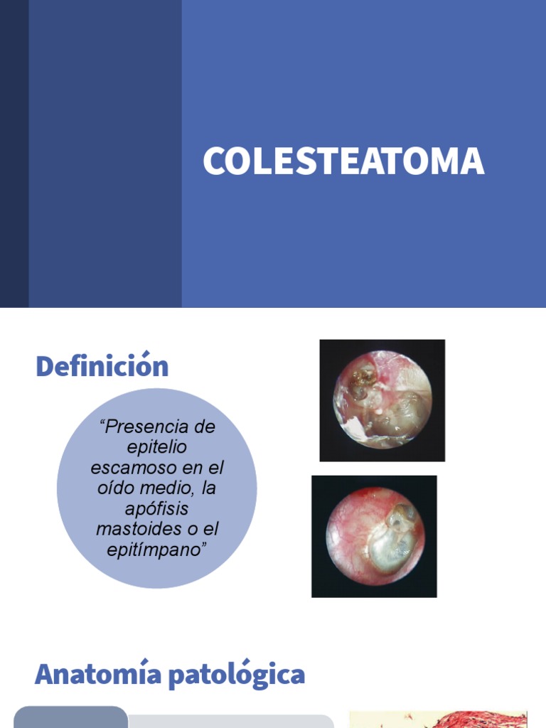 COLESTEATOMA | PDF | Epitelio | Oído