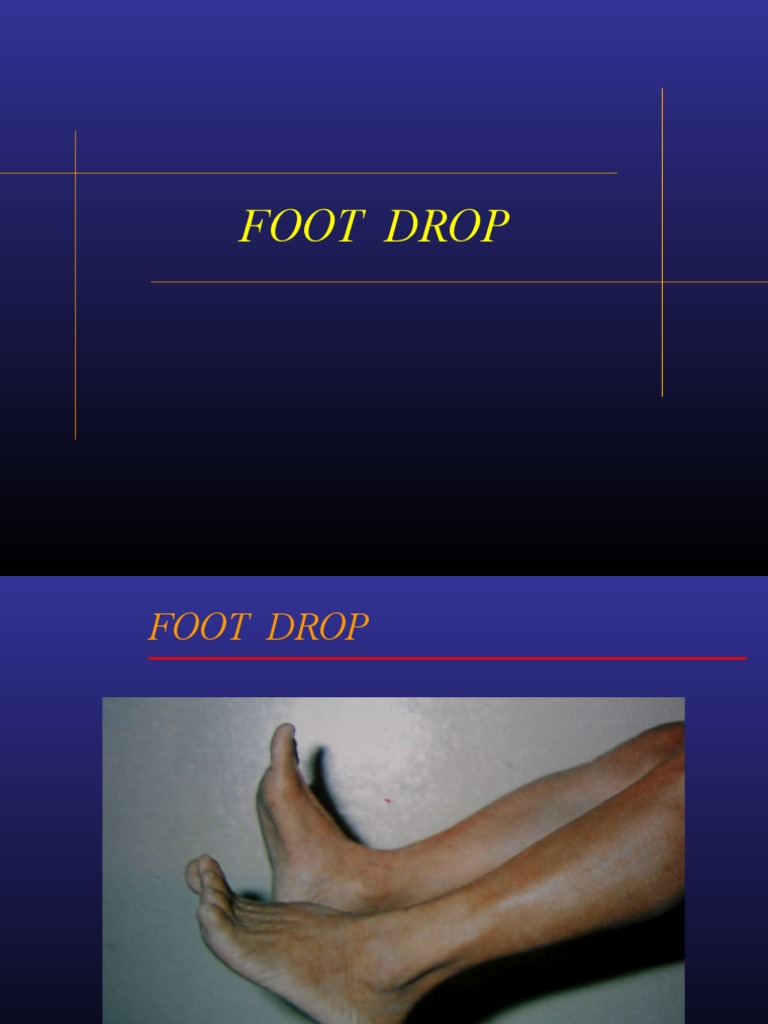 Foot Drop | PDF