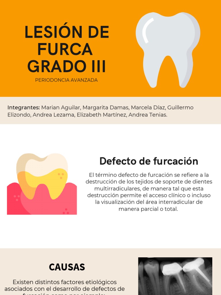 Lesion de Furca Grado Iii | PDF | Hueso | Odontología