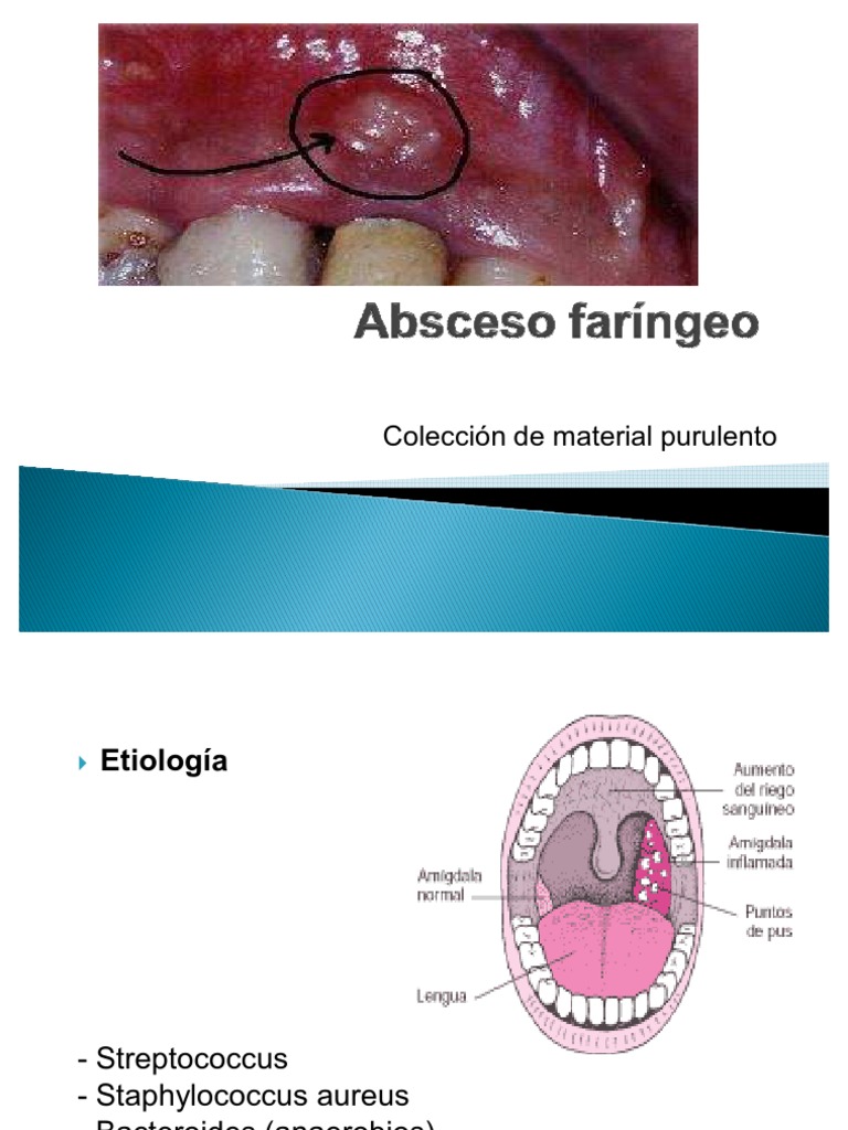Absceso Faringeo | PDF