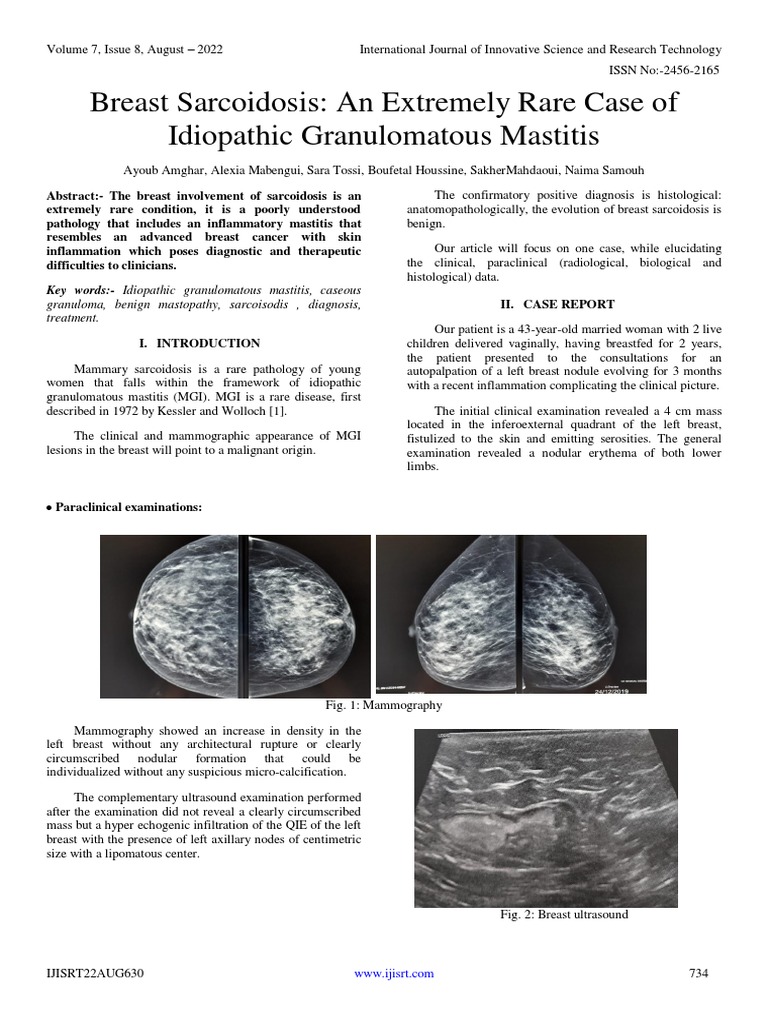 Breast Sarcoidosis An Extremely Rare Case of Idiopathic Granulomatous ...