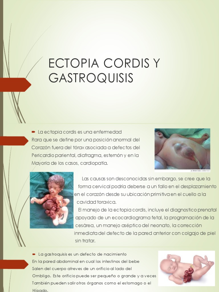 Ectopia Cordis y Gastroquisis | PDF