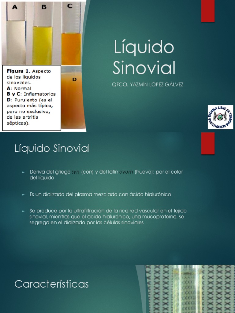Líquido Sinovial | PDF | Rodilla | Inflamación