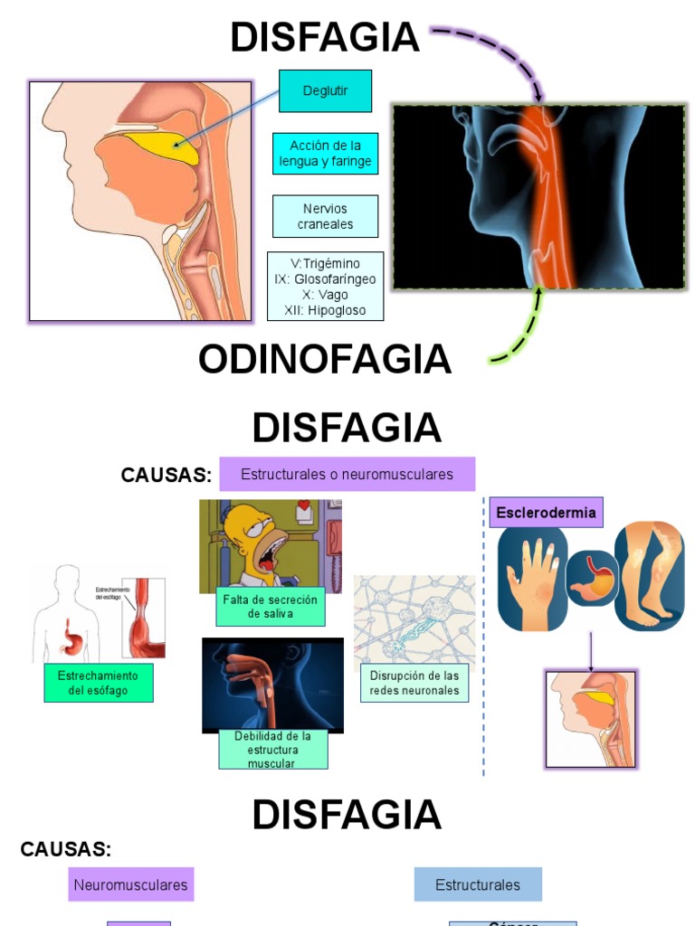 DISFAGIA | PDF