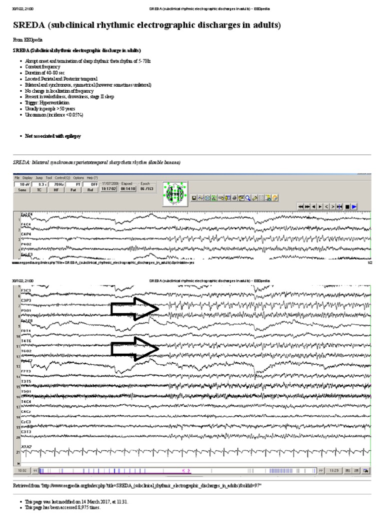 SREDA (Subclinical Rhythmic Electrographic Discharges in Adults) - EEGpedia | PDF