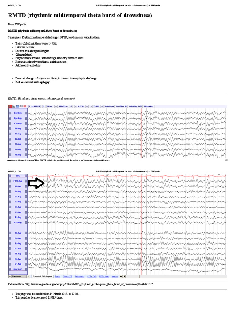 RMTD (Rhythmic Midtemporal Theta Burst of Drowsiness) - EEGpedia | PDF