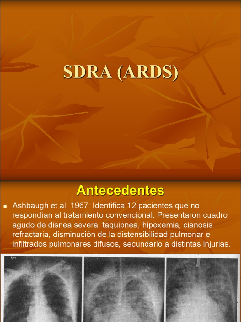 SDRA | PDF | Insuficiencia cardíaca | Neumonía