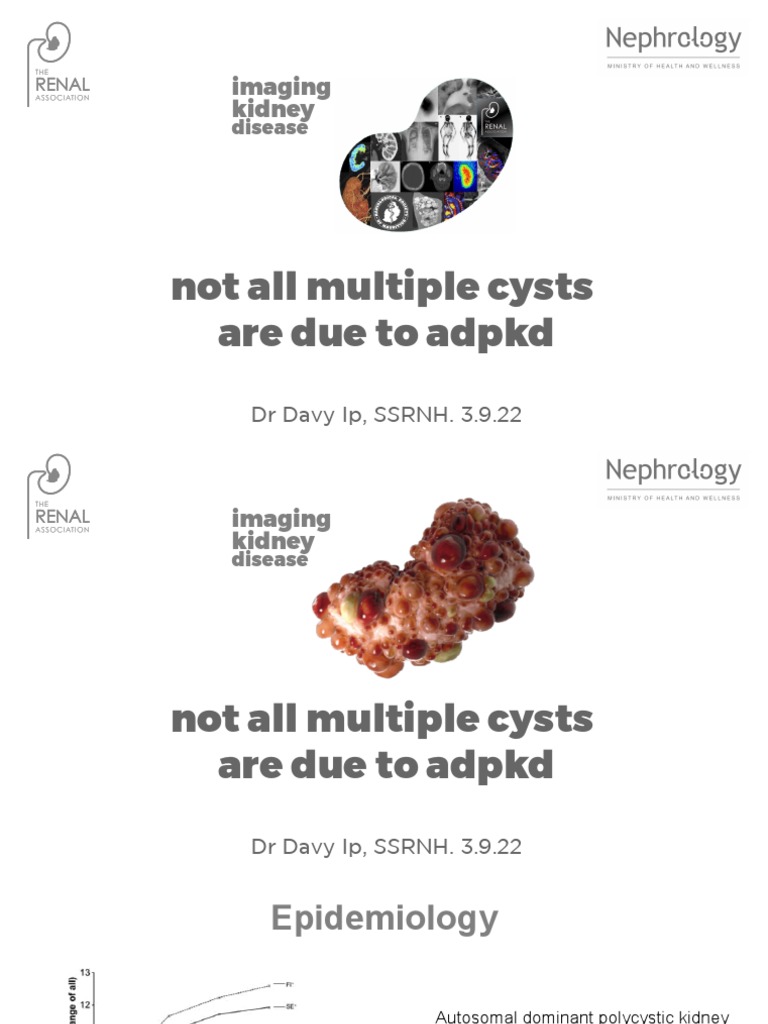 IKD10 - Not All Multiple Cysts Are Due To ADPKD | PDF | Medical ...