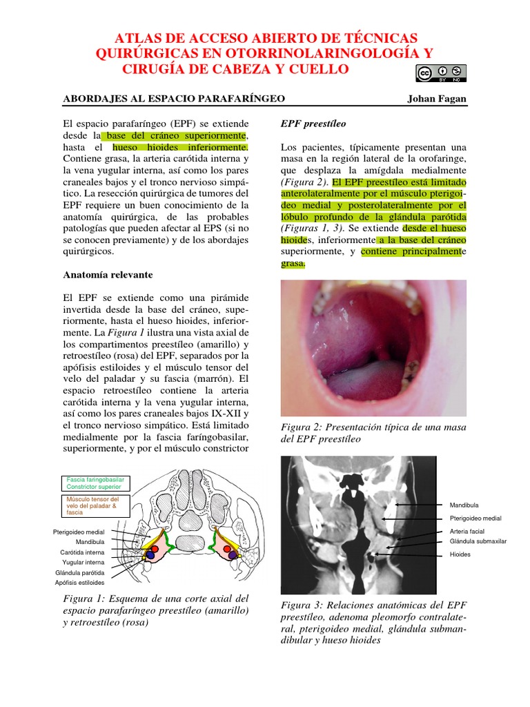 Abordajes Al Espacio Parafaríngeo Maxilofacial | PDF | Anatomía humana ...