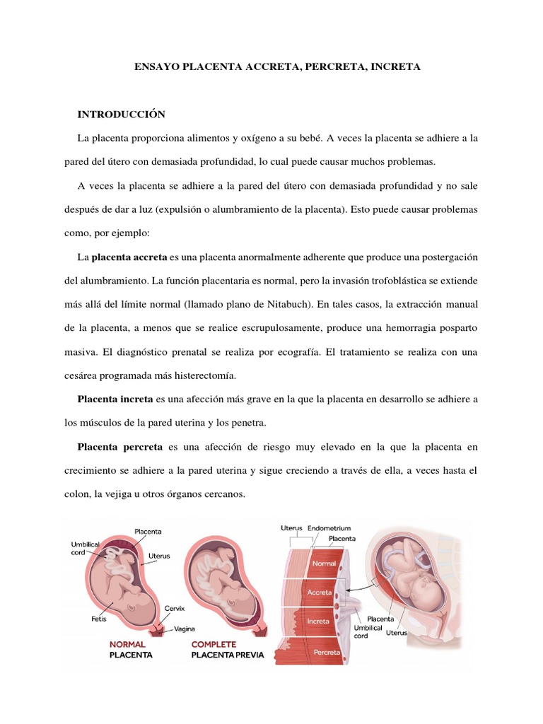 Ensayo Placenta Accreta, Increta, Percreta | PDF | El embarazo | Parto