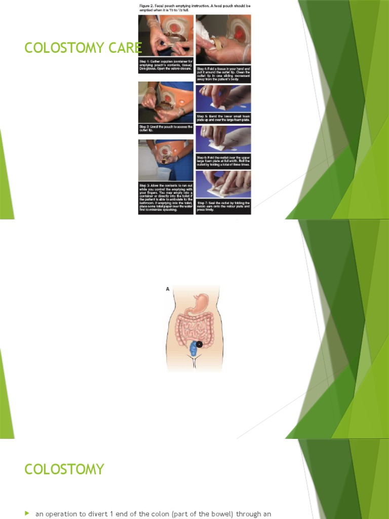 Colostomy Care | PDF | Surgery | Medical Specialties