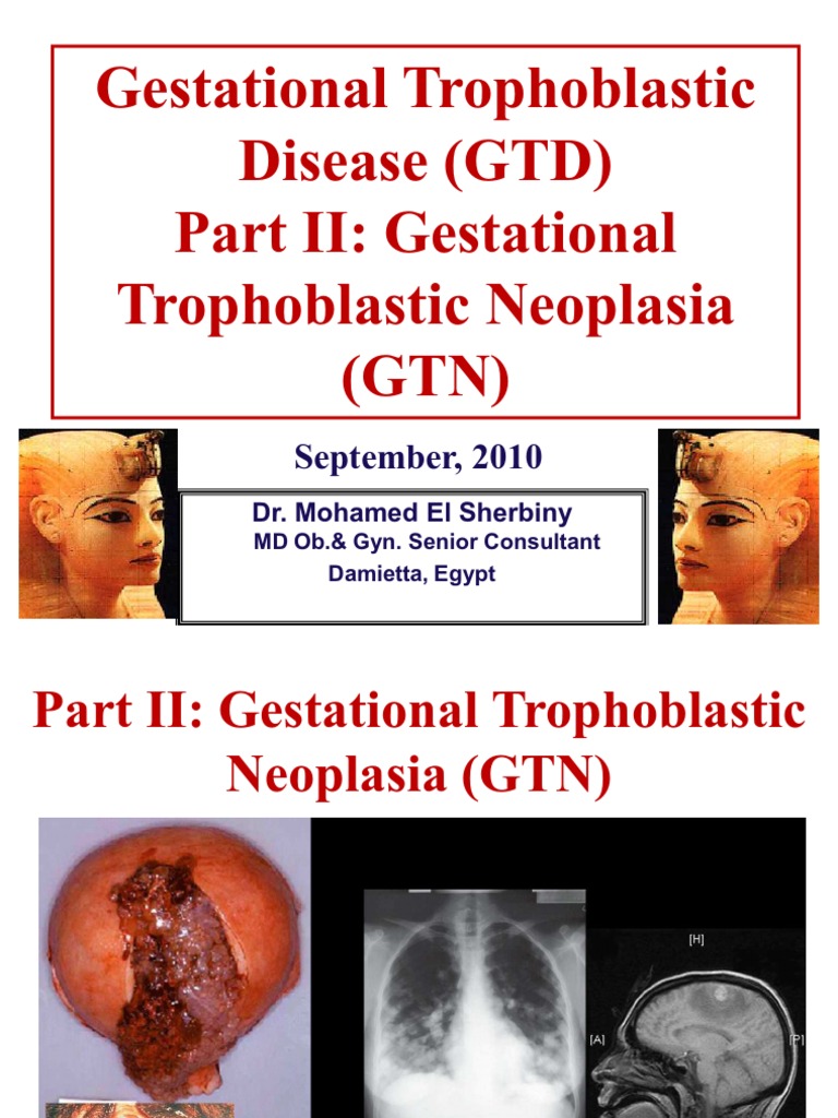 Gestational Trophoblastic Disease Pt2 | PDF | Metastasis | Cancer
