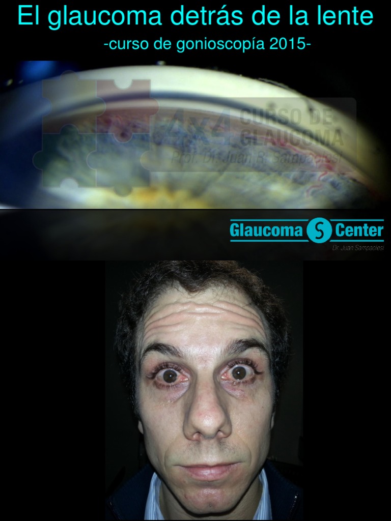 01 Gonioscopia Bases 2015 | PDF | Glaucoma | Ligero 01 Gonioscopia Bases 2015 | PDF | Glaucoma | Ligero