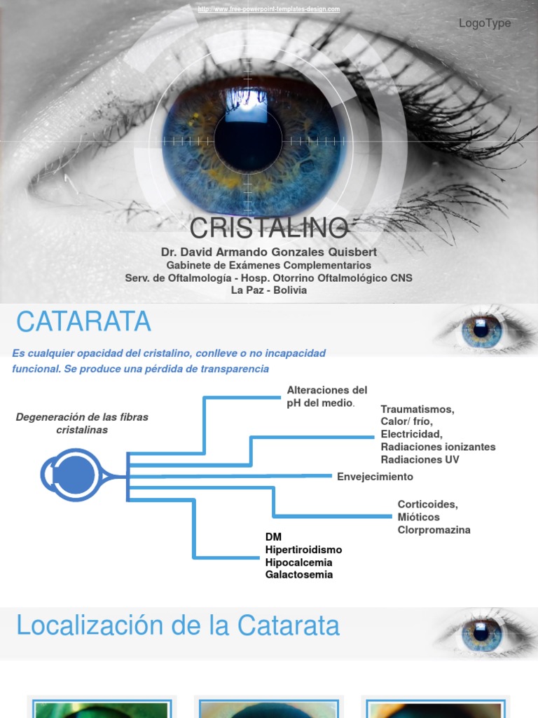 Cristalino - Catarata | PDF | Catarata | Causas de la muerte