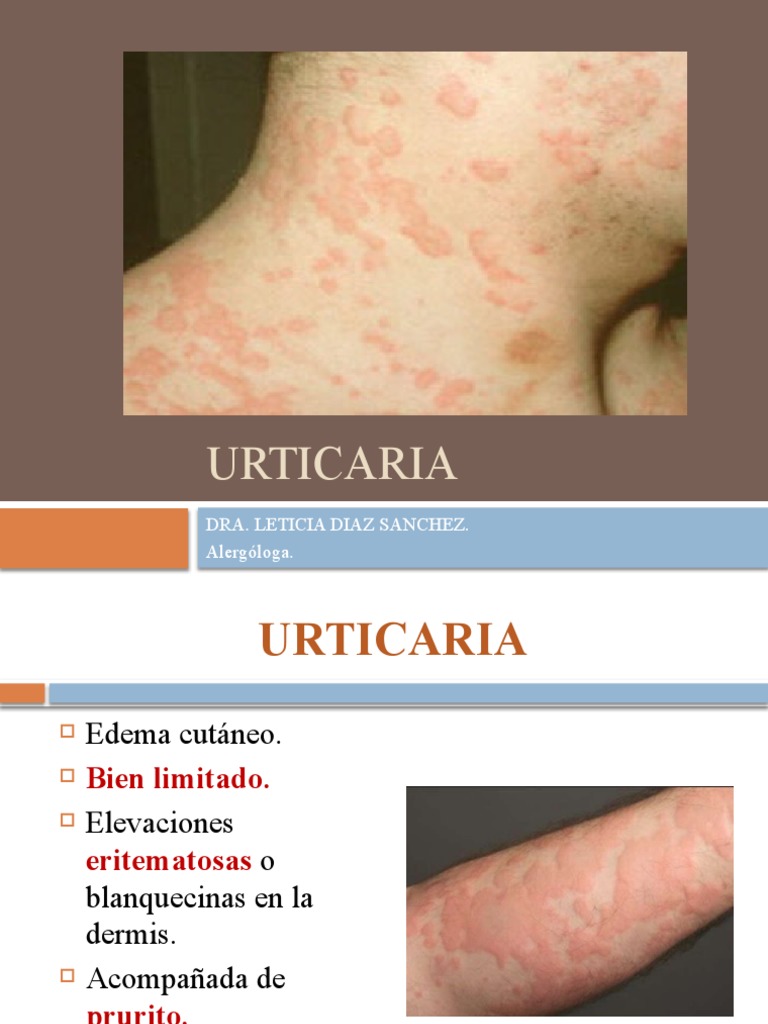 Tipos y Tratamientos de Urticaria | PDF | Aspirina | Alergia