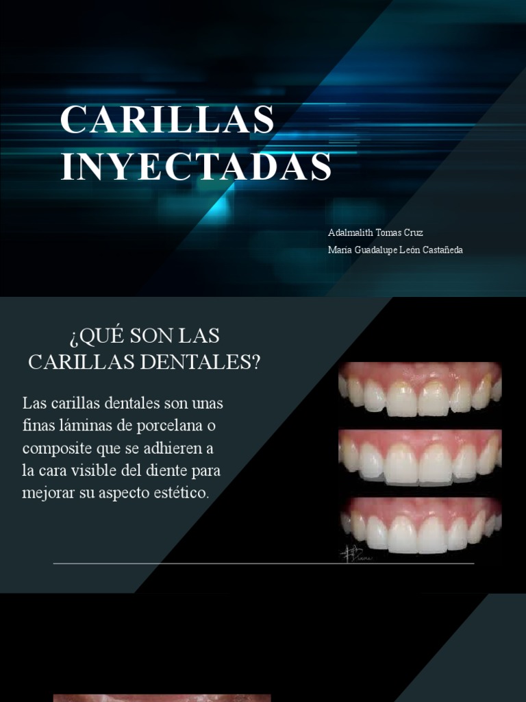 Carillas Inyectadas | PDF | Compuesto Dental | Ramas de Odontología