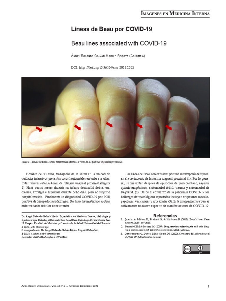 Líneas de Beau y COVID-19 | PDF | Medicina CLINICA | Especialidades Medicas
