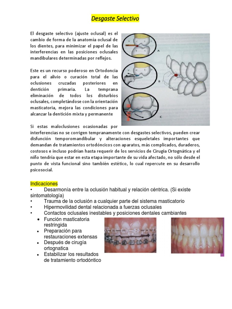 Desgaste Selectivo en Oclusión Dental | PDF | Odontología | Ortodoncia