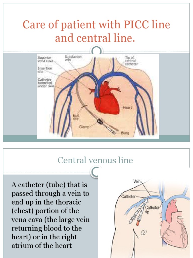 Care of Patient With PICC Line and Central | PDF | Science & Mathematics | Technology & Engineering