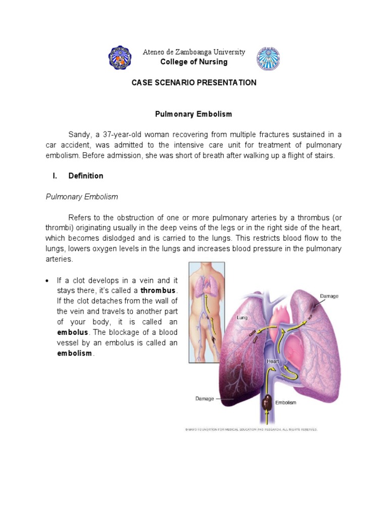 A Case of Pulmonary Embolism: Defining the Condition, Explaining the ...