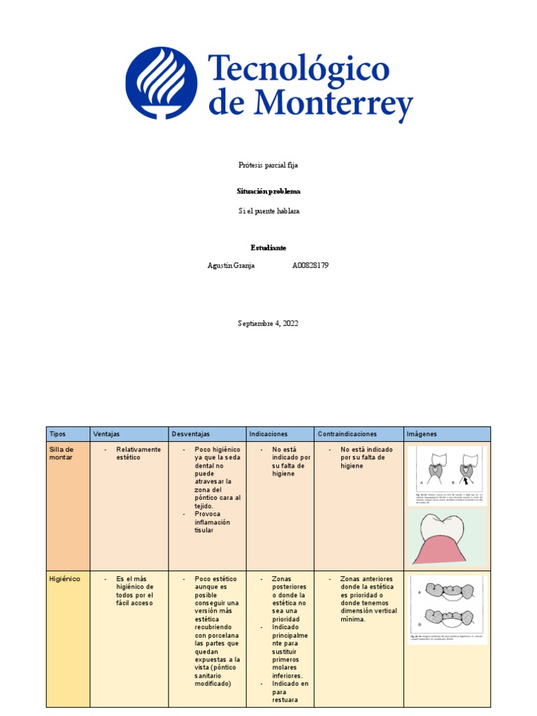 Tipos y características de pónticos | PDF | Dentadura postiza | Ramas ...