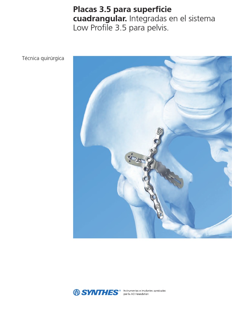 Placa Lamina Cuadrilatera | PDF | Tornillo | Pelvis