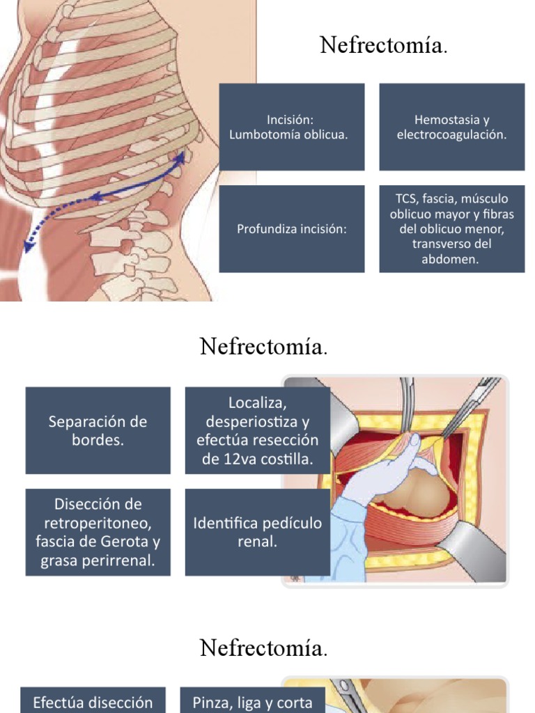 Nefrectomía | PDF