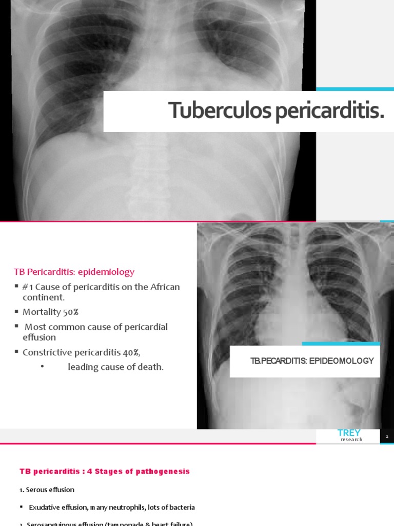 Tuberculous Pericarditis Overview | PDF | Tuberculosis | Medicine