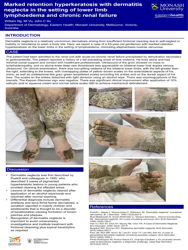 Marked Retention Hyperkeratosis With Dermatitis Neglecta in The | PDF