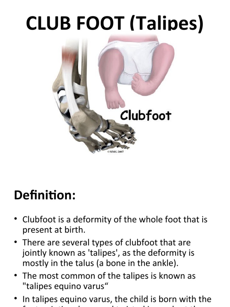 Club Foot | PDF | Ankle | Foot