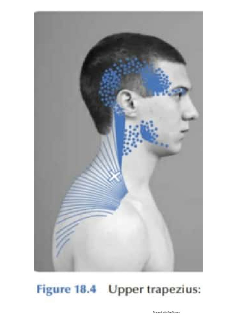 Trigger Points | PDF