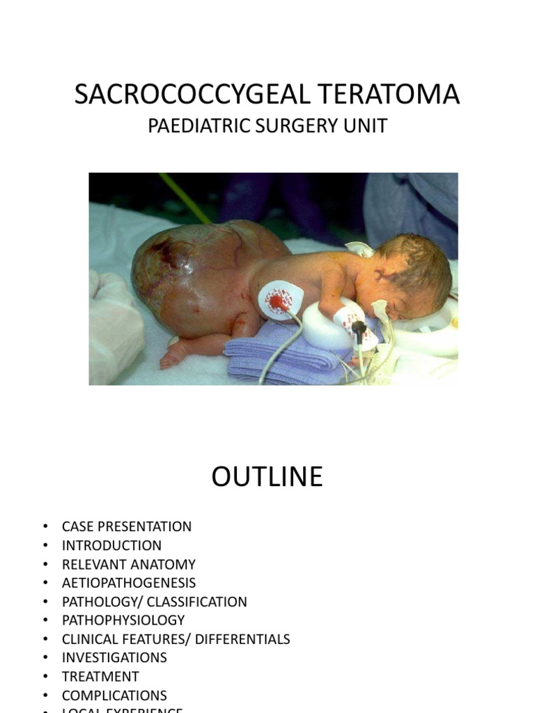 Sacrococcygeal Teratoma Overview | PDF