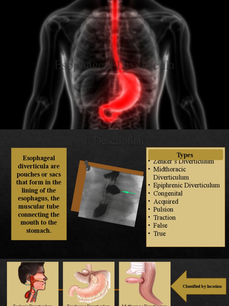Esophageal Diverticula | PDF | Esophagus | Human Diseases And Disorders